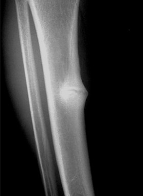 Shin Pain - Foot Pain Centres of Leeds