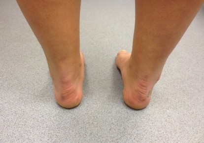 What is Supination? - Foot Pain Centres of Leeds