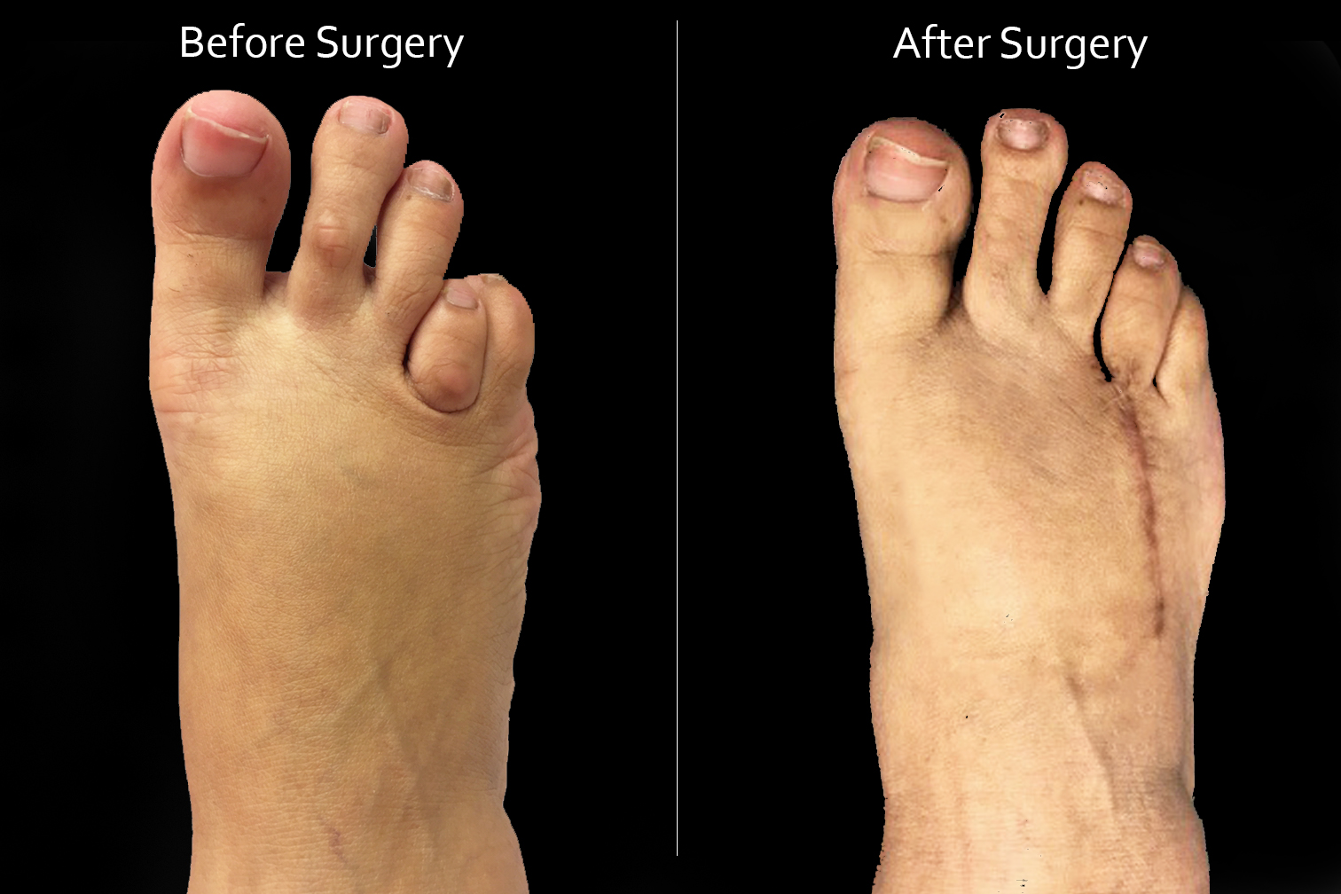Foot Surgery - Foot Pain Centres of Leeds