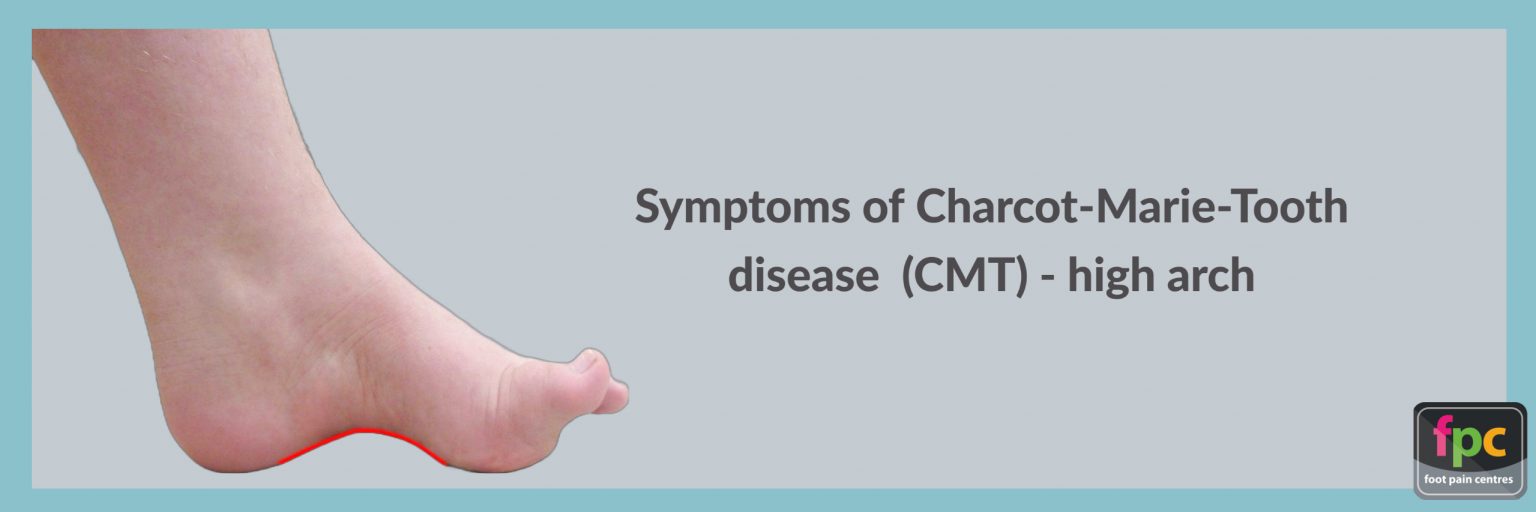 Charcut Marie Tooth (CMT) Symptoms - Foot Pain Centres of Leeds